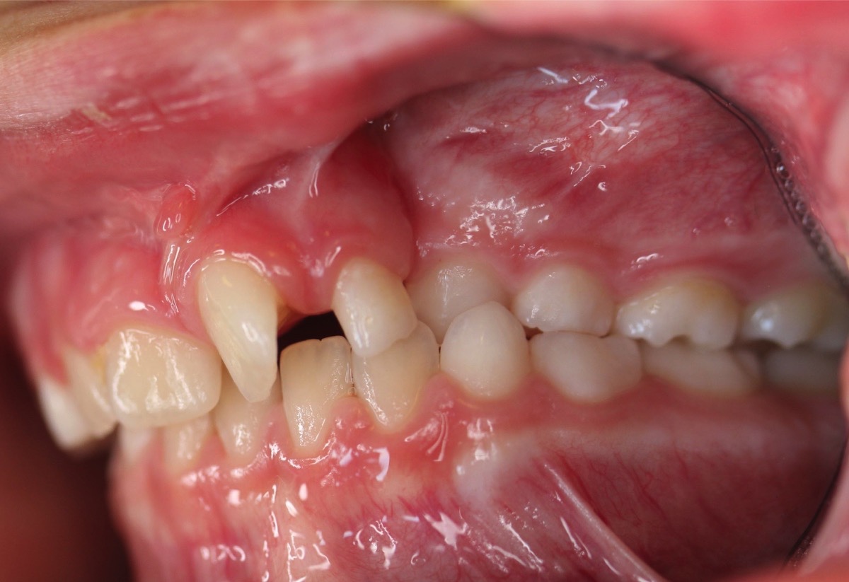 dental problems of patients born with a form of facial cleft